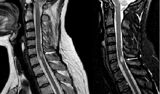 NeuroAnatomía Dr. William Ganem: Mielitis transversa asociada a ...