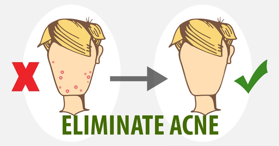 Step By Step Instructions To Eliminate Acne - Fix Our Life