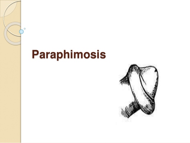 Paraphimosis Treatment - YouTube