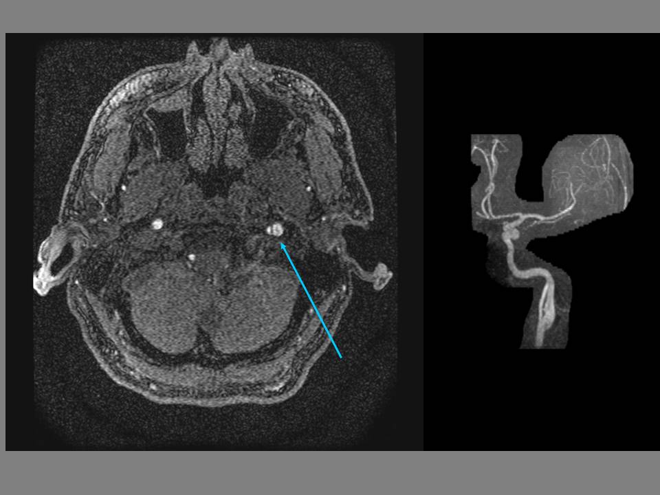 The Pump and the Tubes: Carotid Dissection on MRA