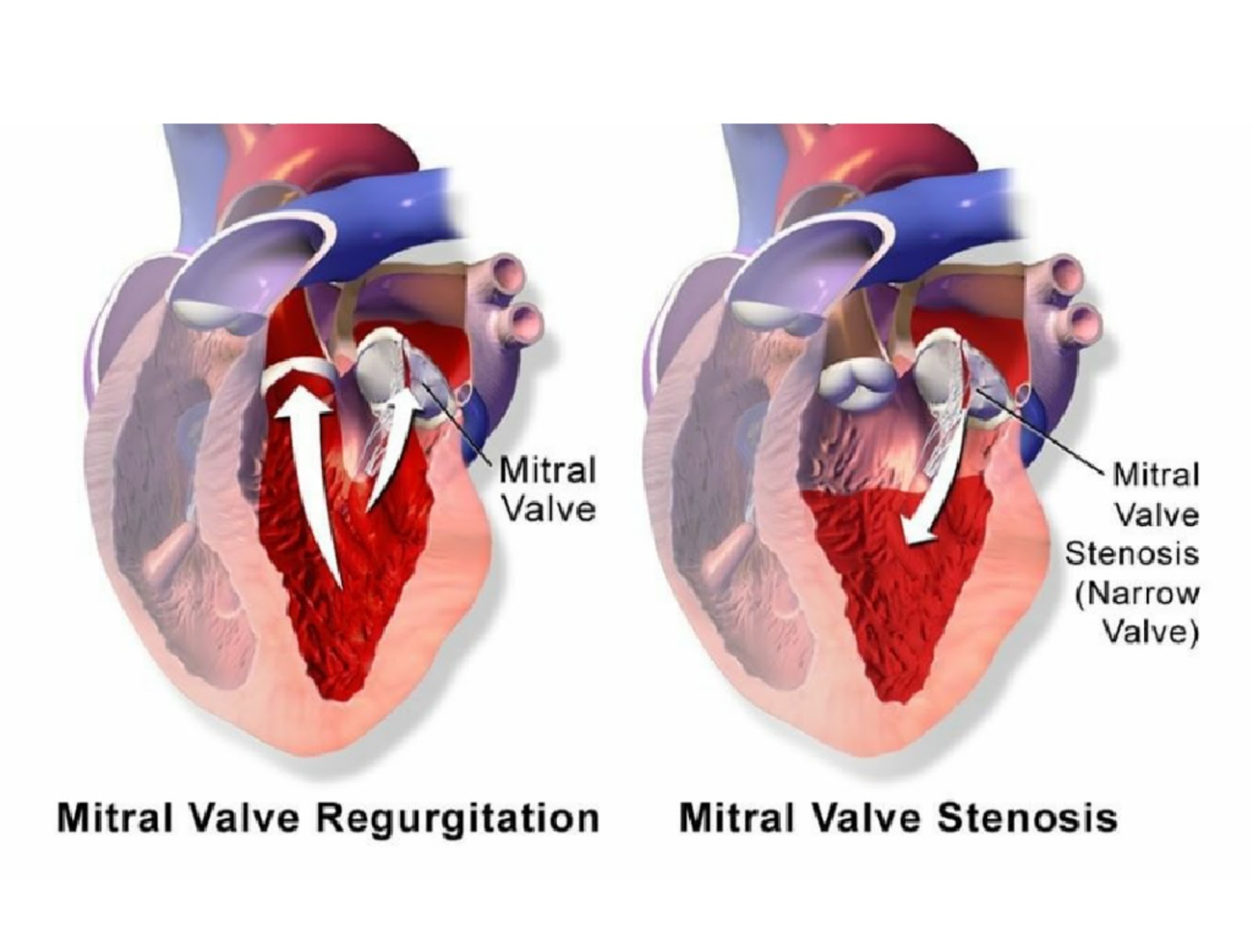 Stenosis Katup Mitral
