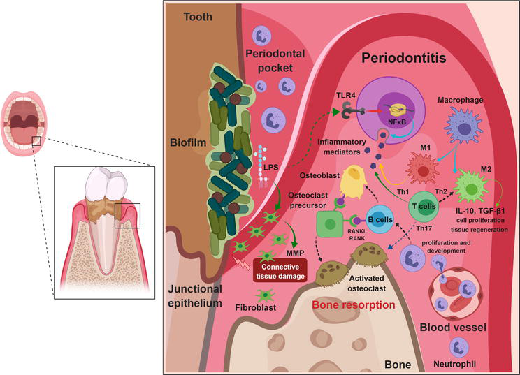 Pathogenesis of Periodontal Disease (8)