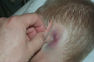 RACOON EYES AFTER A TRAUMATIC HEAD INJURY