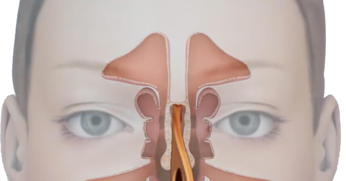 Can a Deviated Septum Cause a Septal Perforation? | Fauquier ENT Blog