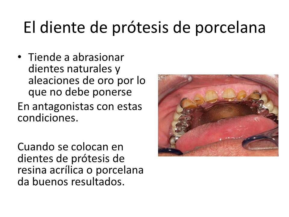 REHABILITACIÓN II: Selección y colocación de dientes artificiales y ...