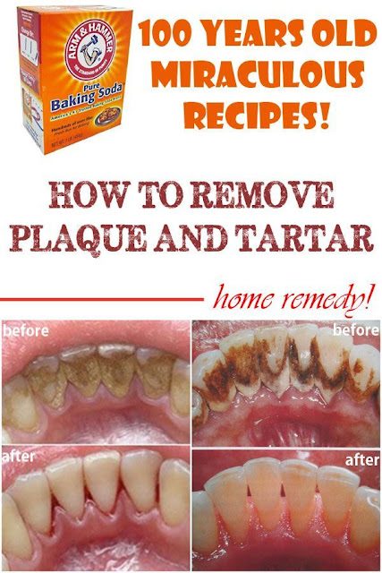 How to Remove Teeth Plaque At Home, Tips to Control Tartar - Healthy ...