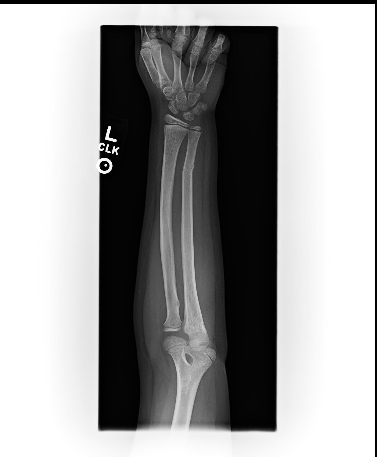 The Munns Family: Our First Broken Bone!