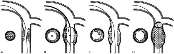 Percutaneous coronary intervention