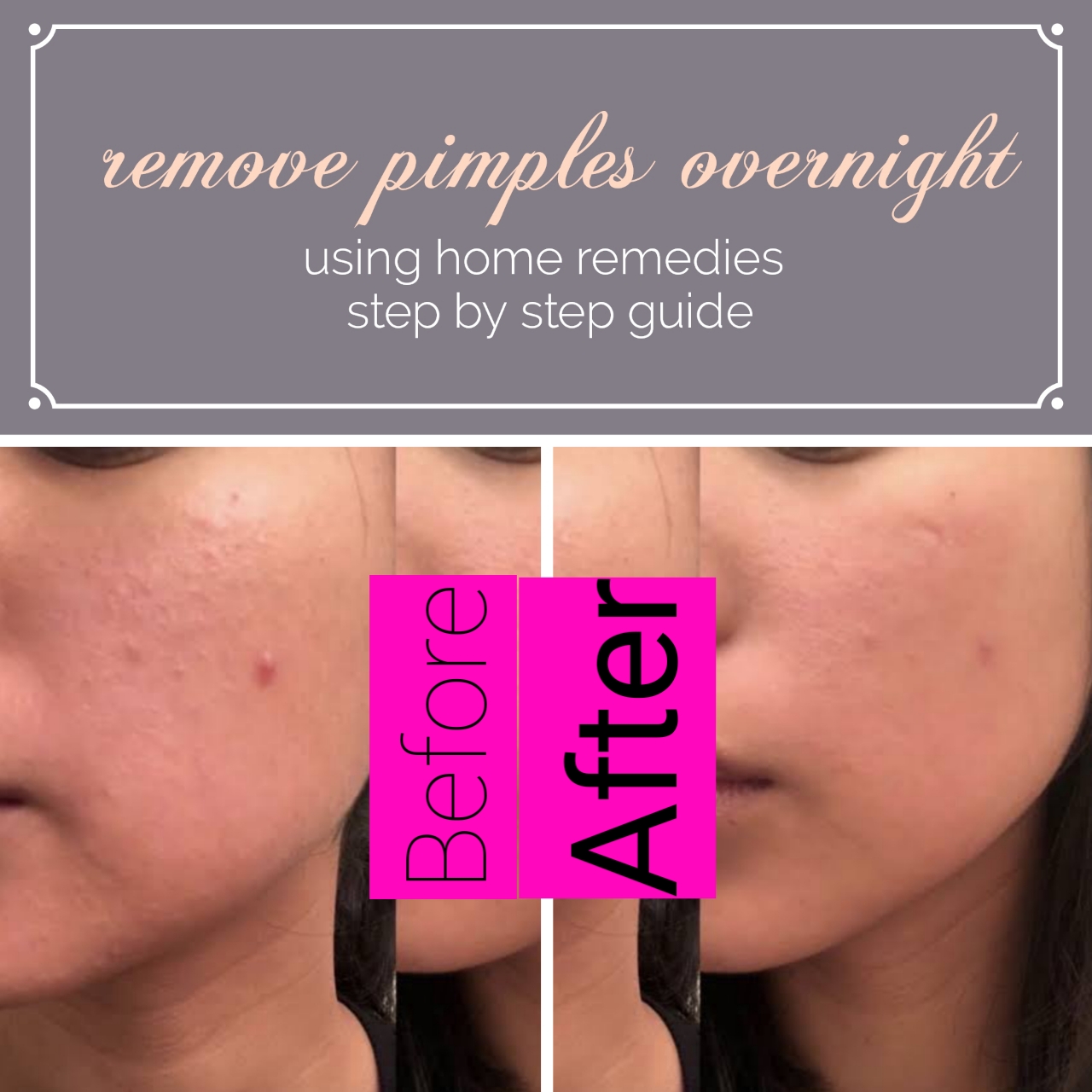 how to remove pimples overnight at home|best and easy method step by ...