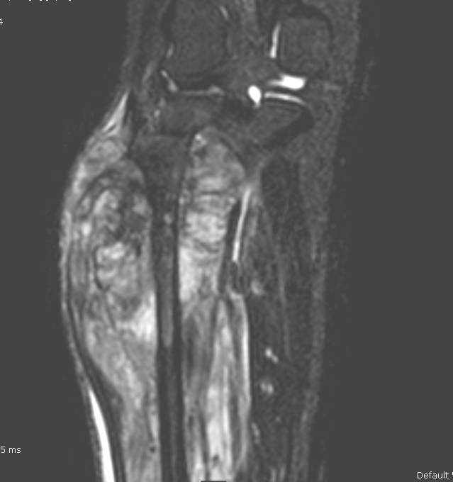 Fibular osteosarcoma-Imaging - Sumer's Radiology Blog