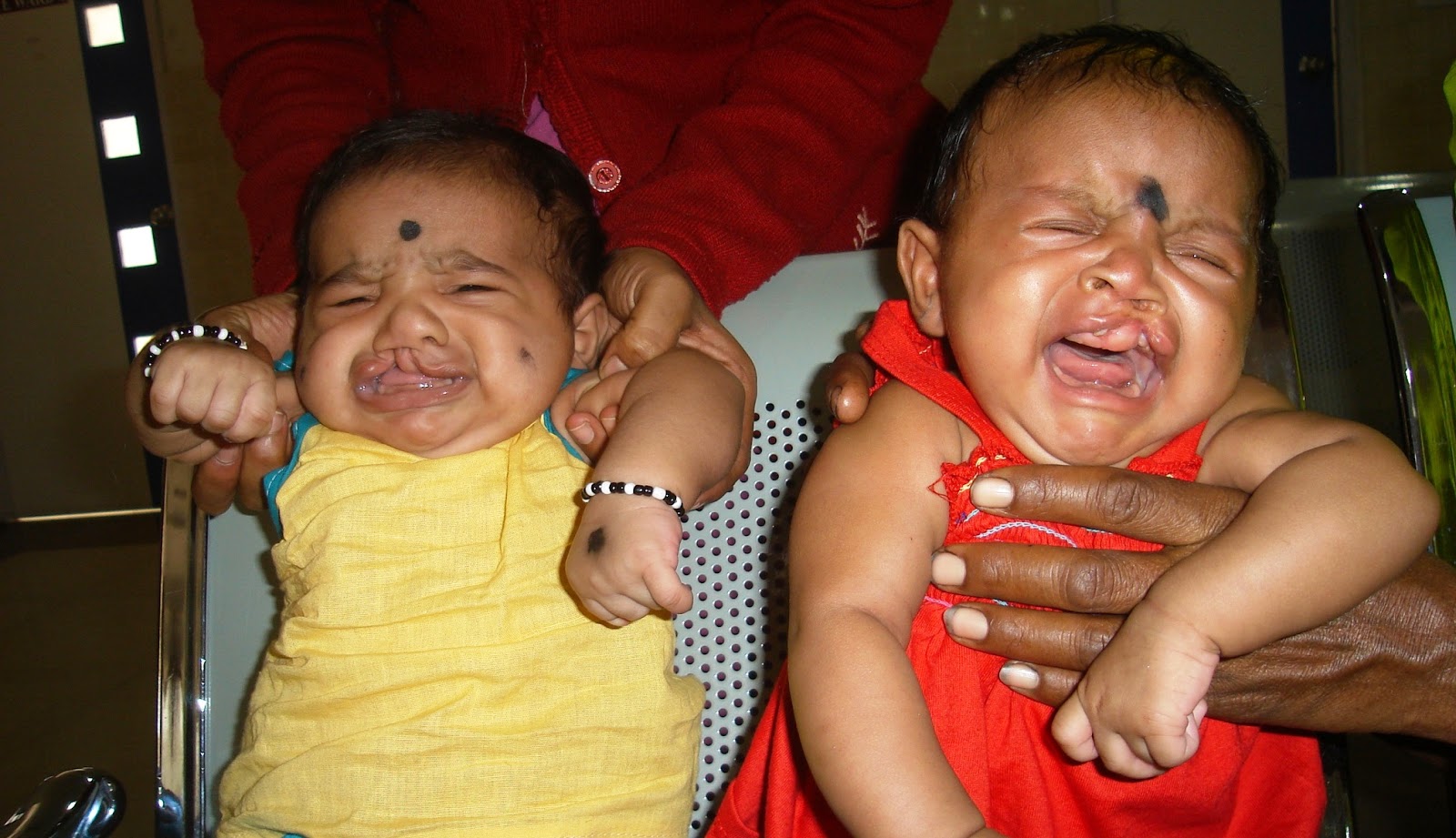 Public Health: Cleft Lip and Cleft Palate
