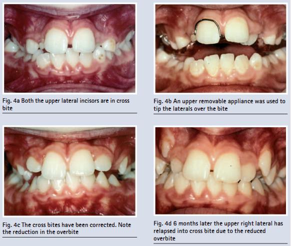 Dentistry lectures for MFDS/MJDF/NBDE/ORE: An Illustrated Note on ...