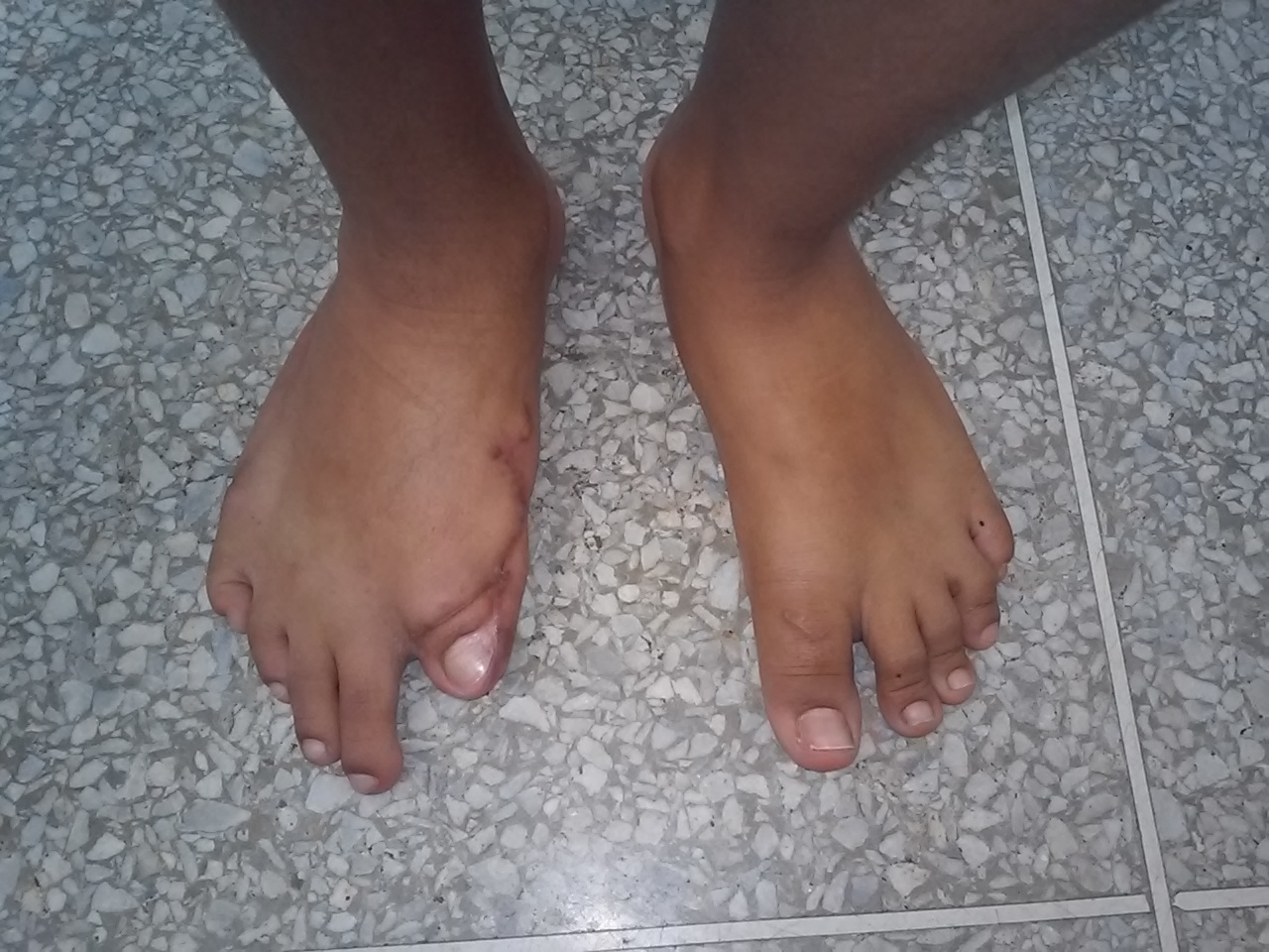 Caso clinico N° 5 Hallux varux congénito