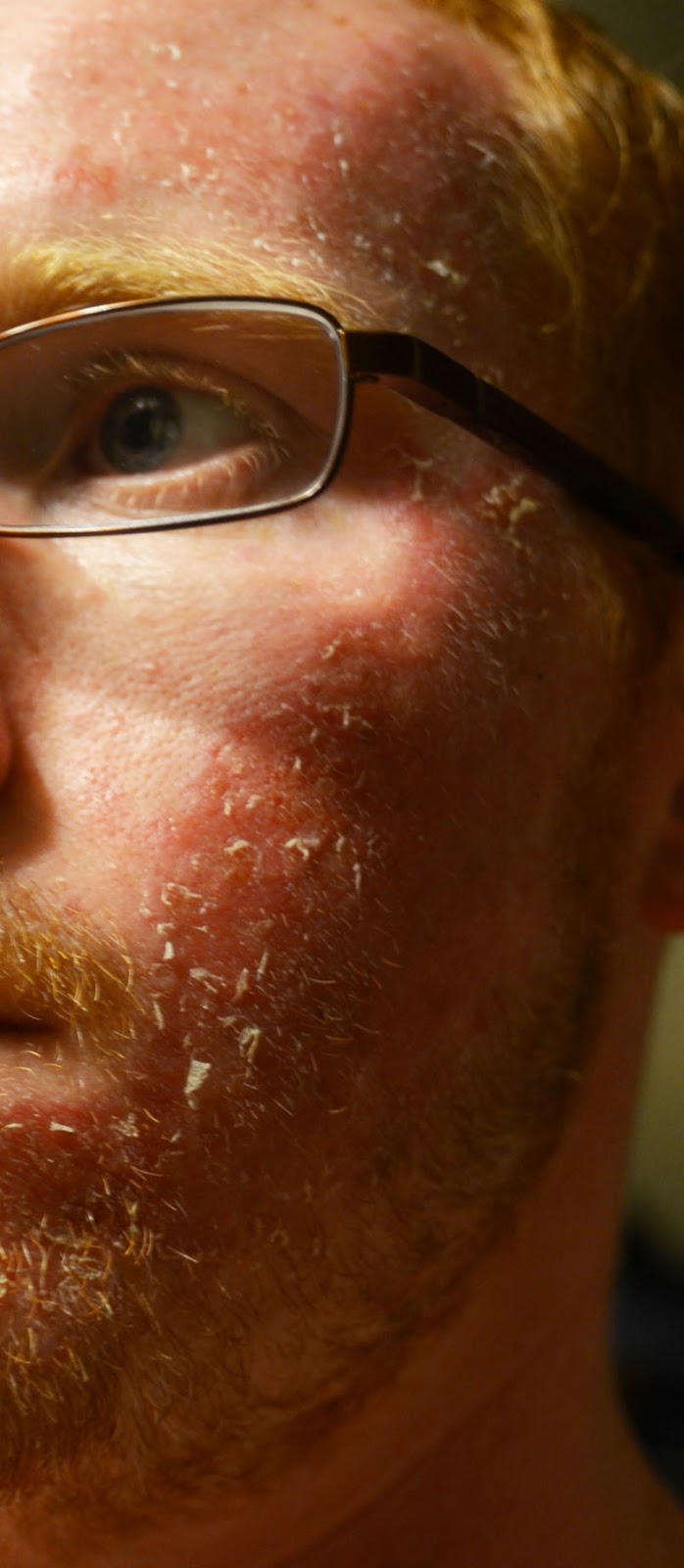 27 Years of Nothing but Failures: Fun with Skin Cancer Part 2!