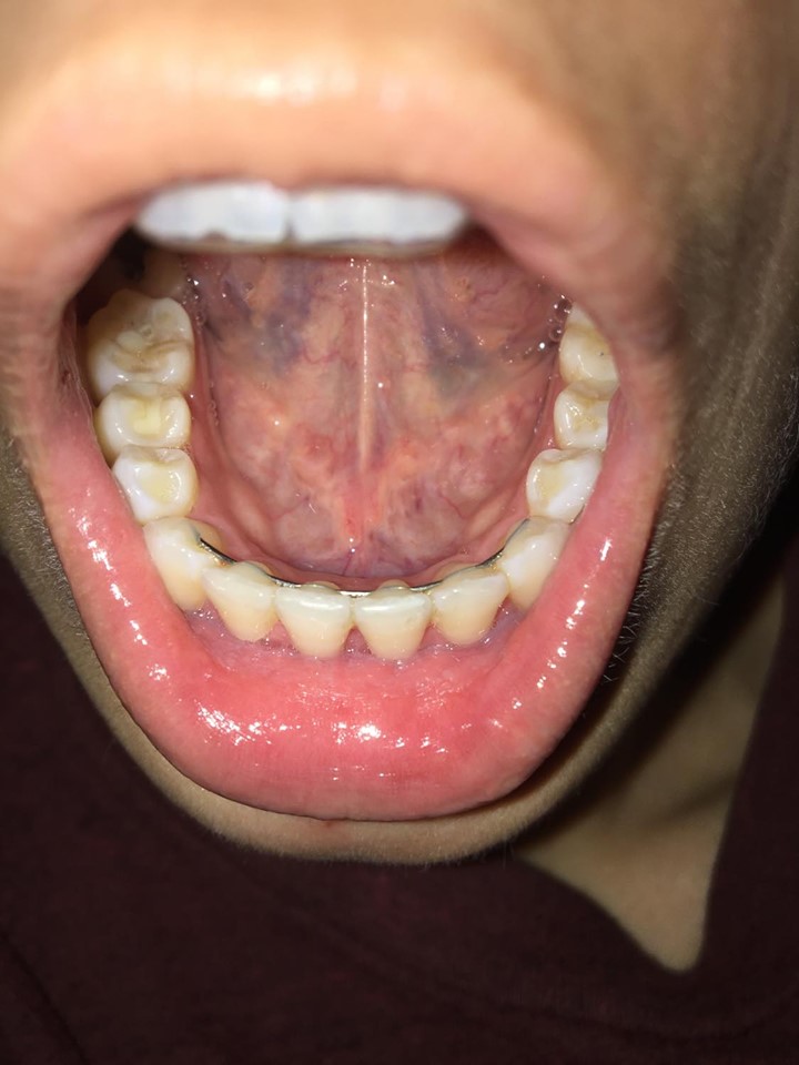The Secret Is Gratitude Mandibular Tori Boney Growths Under The the-secret-is-gratitude-mandibular-tori-boney-growths-under-the