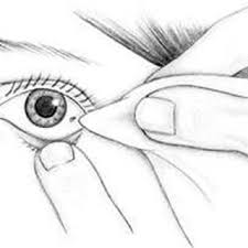 CUERPOS EXTRAÑOS EN OJOS