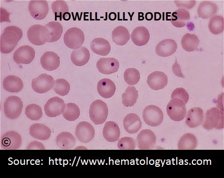 Lab Atlas: Howell Jolly Bodies