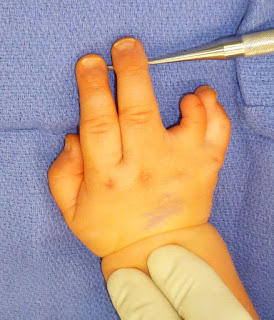 Ulnar cleft hand, part II | Congenital Hand and Arm Differences ...