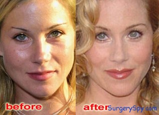 Christina Applegate Before and After - Celebrity Before and After