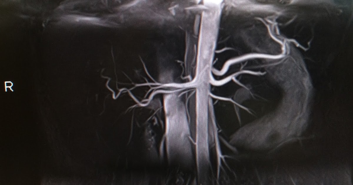 RESONANCIA MAGNETICA AL DIA : ANGIO RM DE ARTERIAS RENALES SIN ...