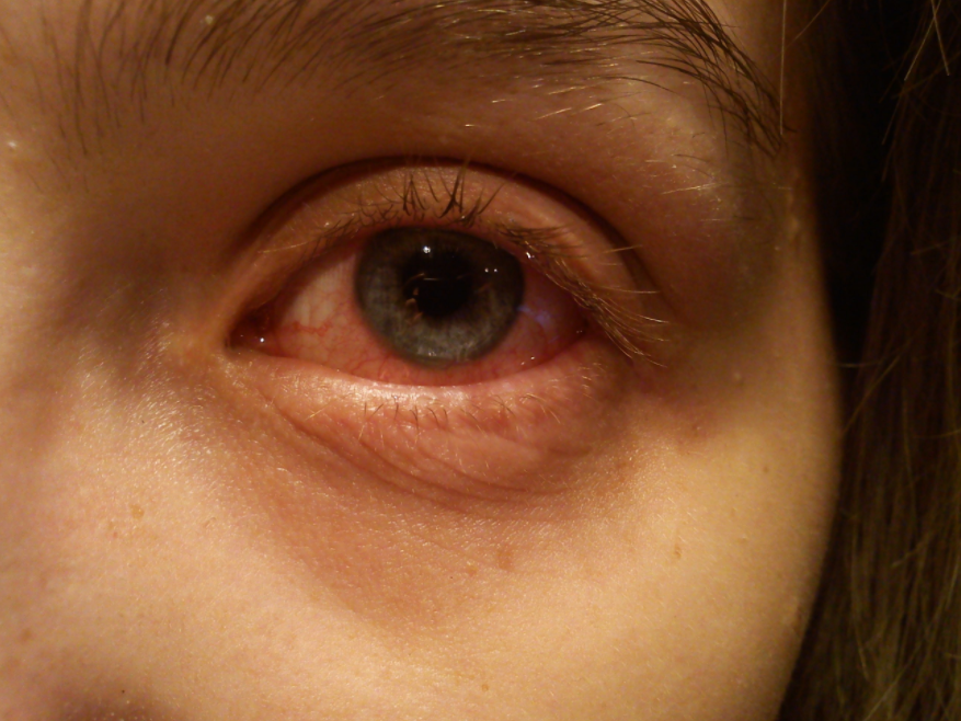 Mata Merah / Konjungtivitis / Penyakit Mata
