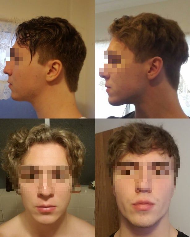 Những điều bạn cần biết về mewing ~ The beausty