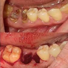 Salud Pública en Venezuela: Caries dentales y restos radiculares un ...
