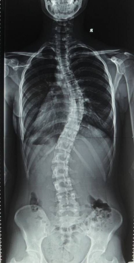 RADYOLOJİ TIBBIN GÖREN GÖZÜ...: SKOLYOZ
