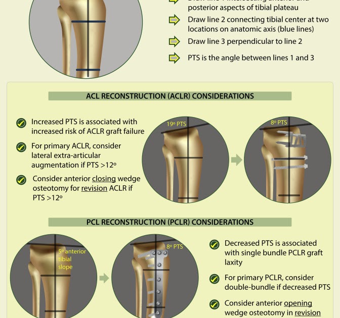 Revisiones_bibliográficas TyO_Web: Pendiente tibial posterior ...
