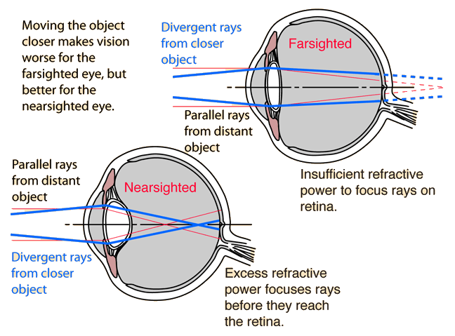 Nearsightedness and Farsightedness at Intermediate Distances.