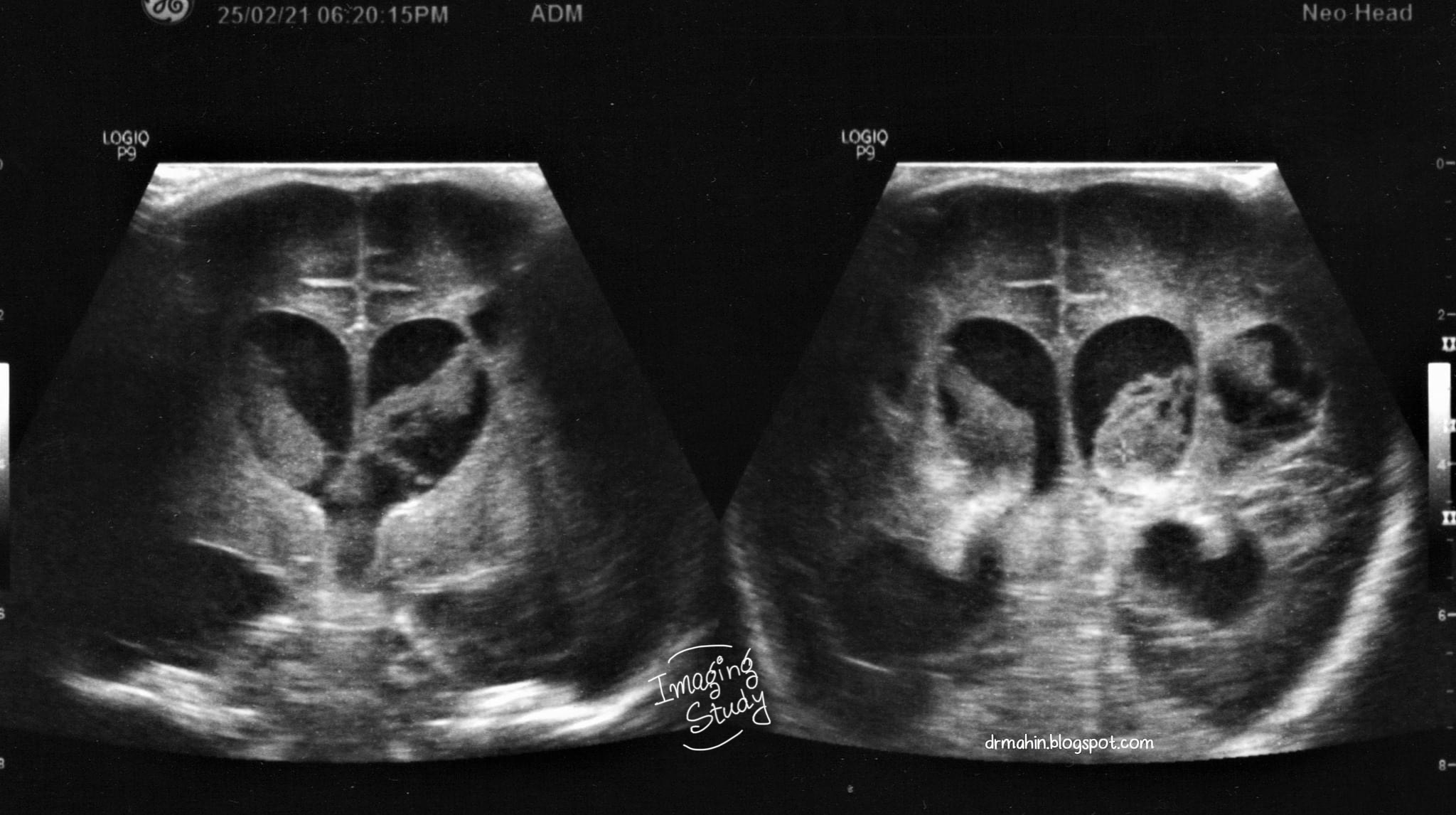 Case 32: Grade IV Intracranial Hemorrhage ~ Imaging Study