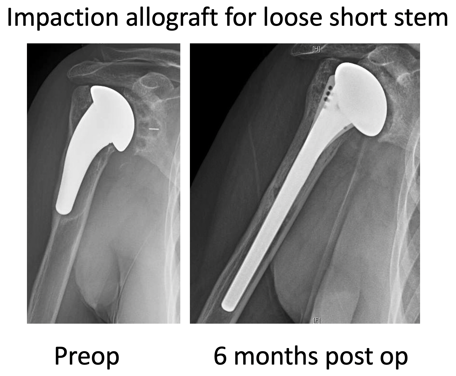 UW Shoulder and Elbow Academy: Total shoulder arthroplasty: is a short ...