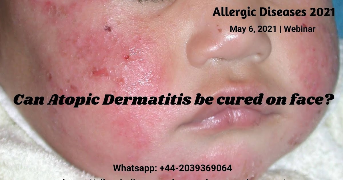 Can Atopic Dermatitis be cured on Face?