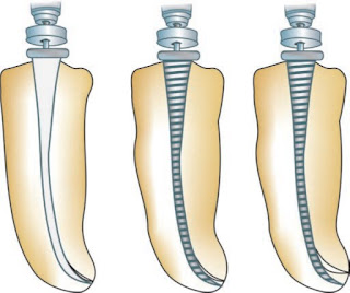 What is Ledge, Zipping, Strip Perforation and Apical Transportation in ...