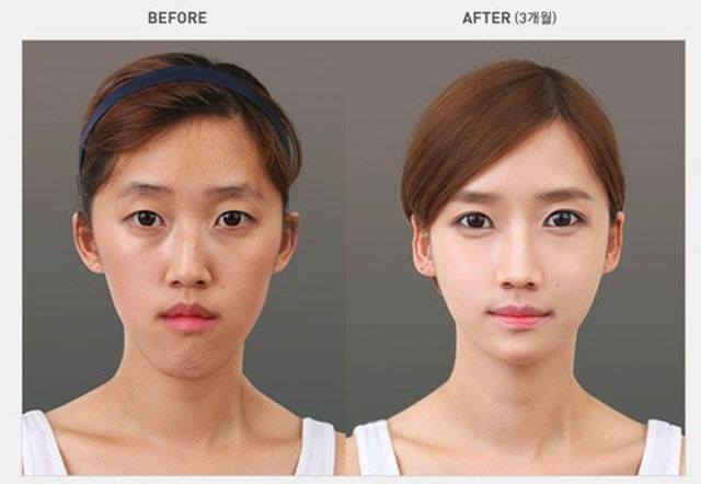 15 Foto 'Before - After' Hasil Operasi Plastik yang Menakjubkan