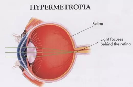 Hypermetropia type , causes and treatment by sharp vision