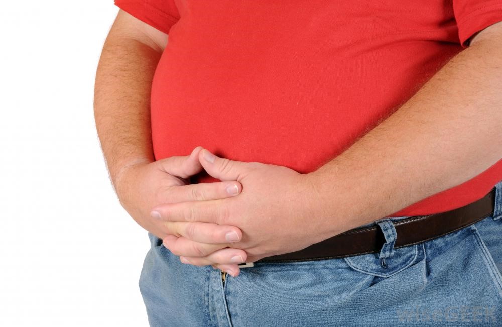 MRA Alerts And Updates Coding For Morbid Obesity mra-alerts-and-updates-coding-for-morbid-obesity