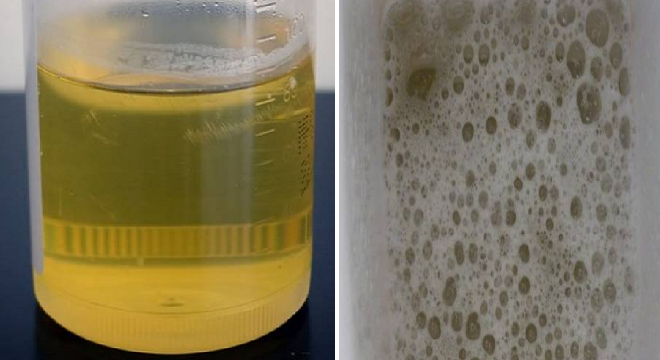 BAHAYA! Inilah 6 Penyebab Pipis Kamu Berbusa dan Berbau Aneh,No 6 Pasti ...