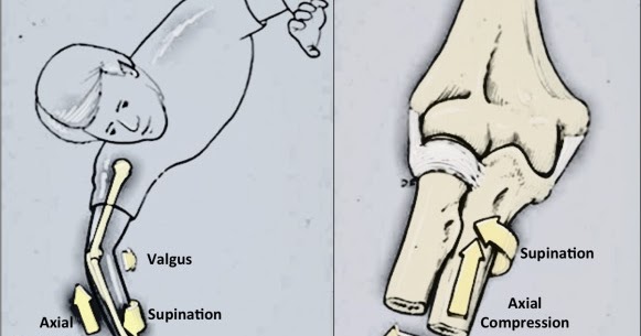 Injuries Around the Elbow - Tips Health 24 Hours