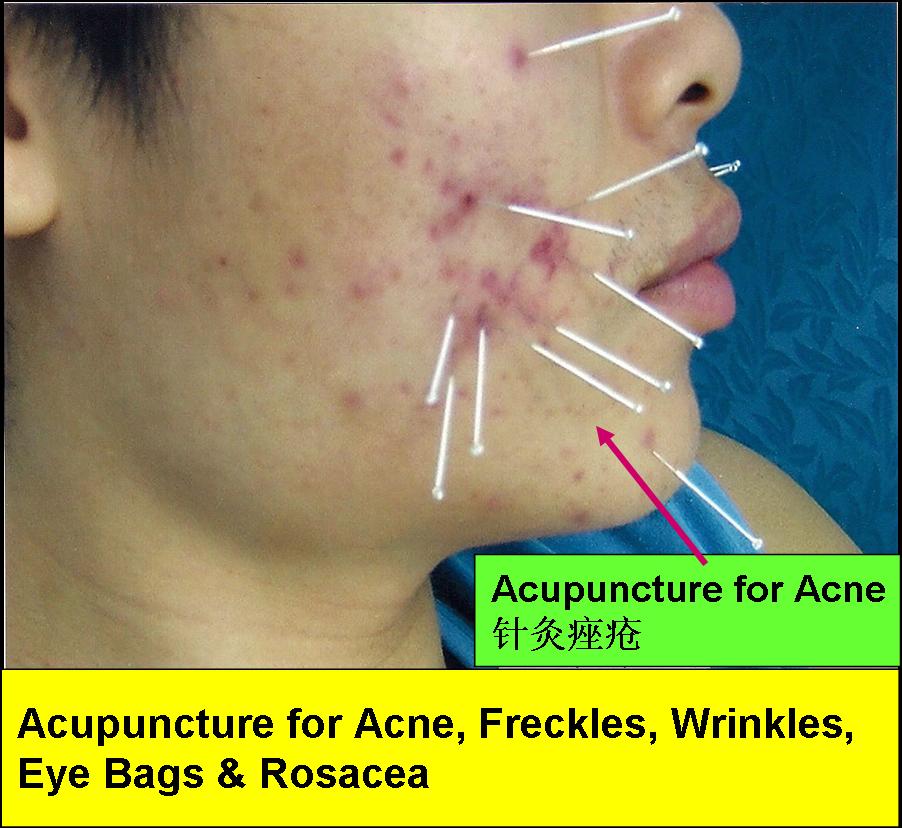 TCM News: TCM Physician Facial Treatment for Acne, Freckles, Wrinkles ...
