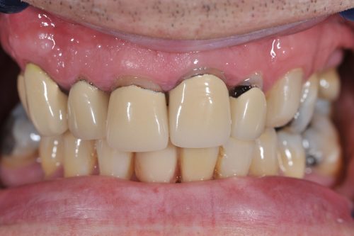 Porcelain-Fused-To-Metal (PFM) Crown And Bridge ~ Dr. Bharat Katarmal ...