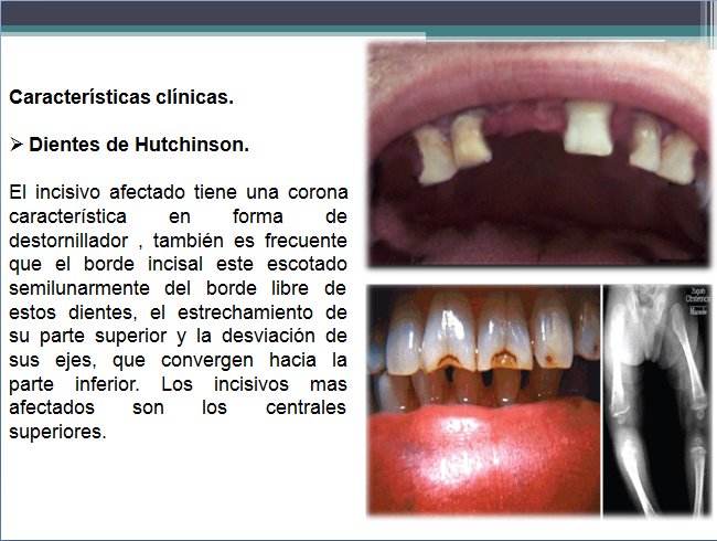 DENTAL 1001 UNAM: Macro y Microdoncia, y otras Anomalías Dentales ...