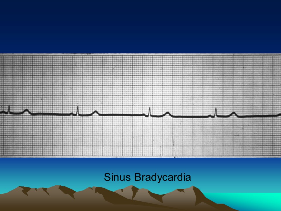 CVT Mohd Farid: Electrocardiogram ECG Part III Basic ECG Rhythm Pattern ...