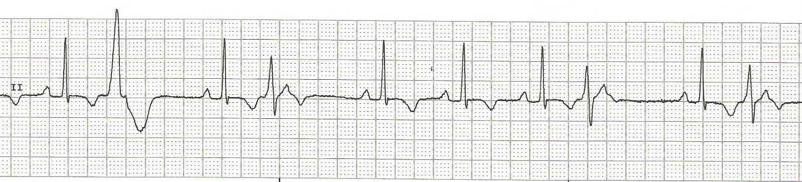 ECG Rhythm Strip Quiz 63
