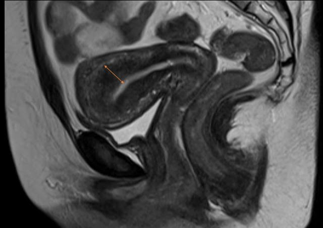 Ultimate Radiology : Adenomyosis of Uterus