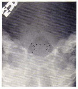 SILLA TURCA AXIAL AP (METODO DE TOWNE)