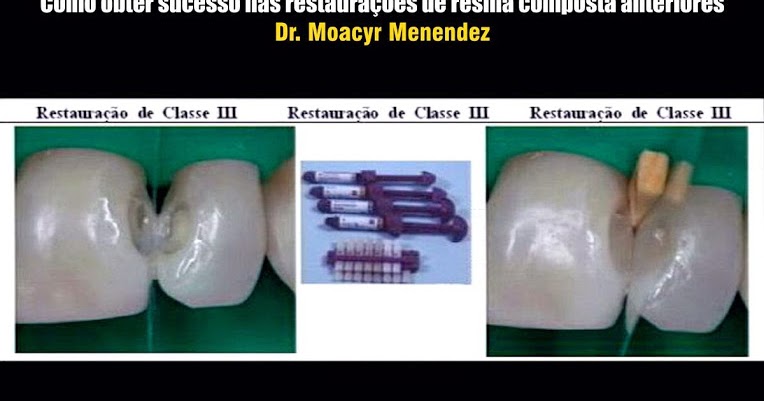 DENTÍSTICA: Como obter sucesso nas restaurações de resina composta ...