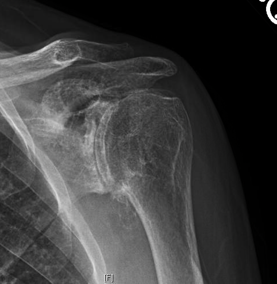 UW Shoulder and Elbow Academy: The severe B2 glenoid in an active man ...