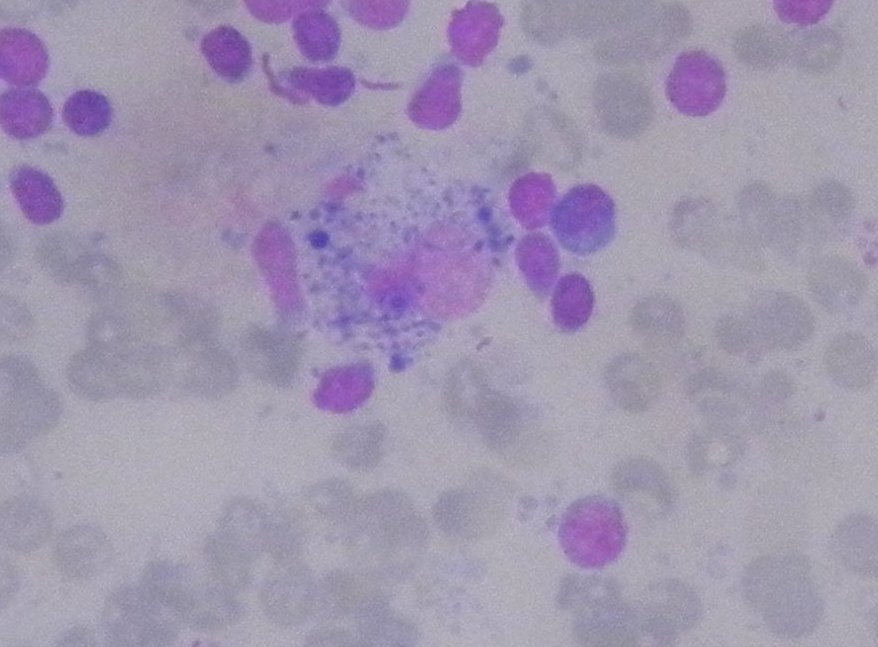 Findings from a lymph node