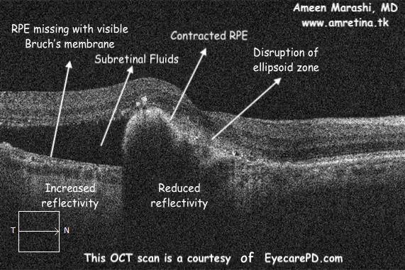 RPE tear, and it's OCT features in a nutshell